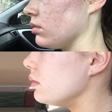 Dermapen Microneedling Anti-Ageing Treatment - Nicola Quinn Day Spa