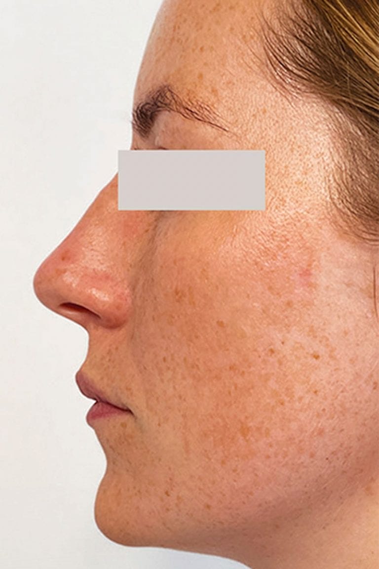 Dermapen Microneedling Anti-Ageing Treatment - Nicola Quinn Day Spa