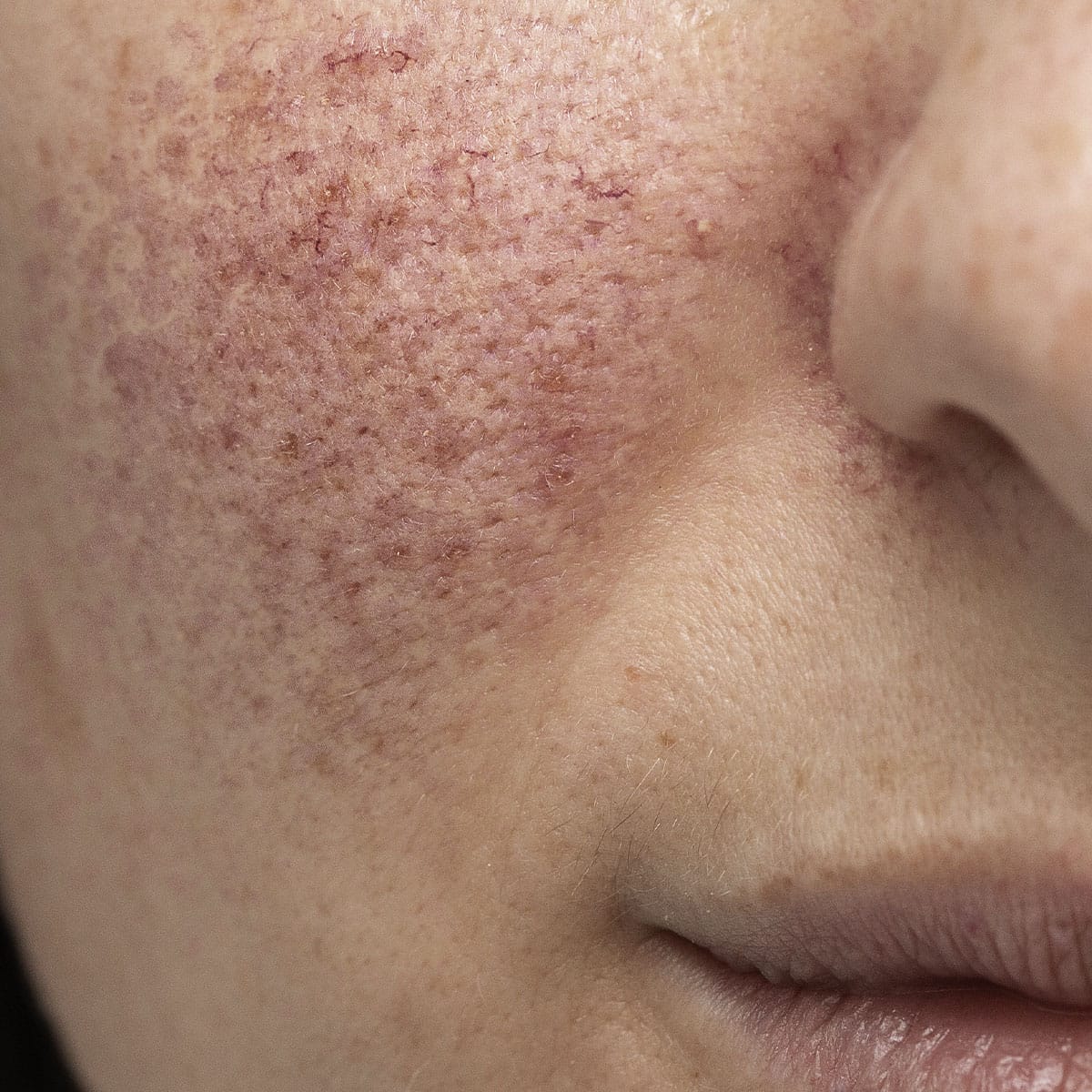 Skin Redness & Sensitivity - Nicola Quinn Spa